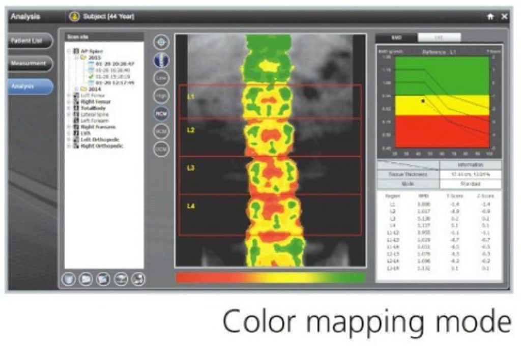 Osteodensitometru whole body Primus Osteosys – Doctorplus.ro