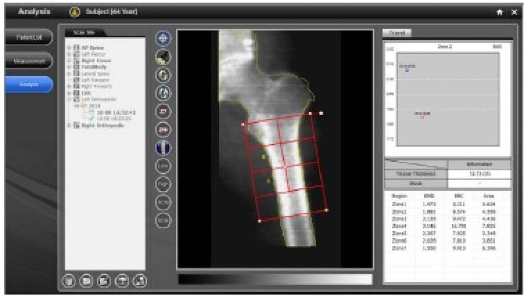 Osteodensitometru whole body Primus Osteosys – Doctorplus.ro